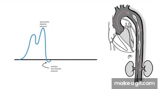 Intra-Aortic Balloon Pump on Make a GIF