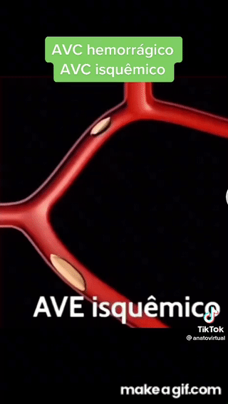 avc isquemico on Make a GIF