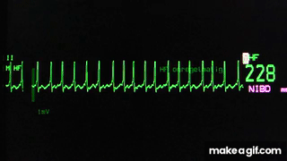 atrial fibrillation with rapid ventricular rate on an ECG heart monitor ...