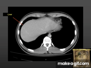 CT abdomen on Make a GIF