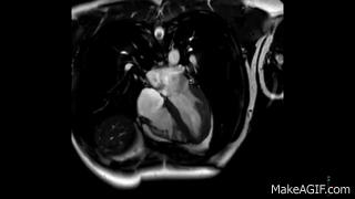 Cardiac MRI scan shows a heartbeat in high resolution on Make a GIF