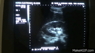 ultrasound for renal stone on Make a GIF