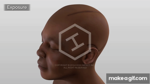 Craniotomy - Traumatic Brain Injury Animation on Make a GIF