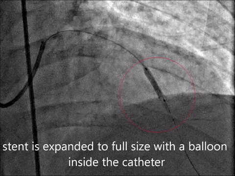 coronary artery angioplasty with stenting on Make a GIF