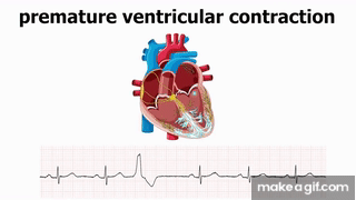 Premature Ventricular contraction (PVCs) on Make a GIF