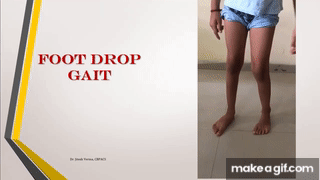 Abnormal Gait in children II videos of Gait types-spastic, scissoring ...