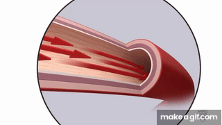 Spontaneous coronary artery dissection (SCAD) Animation on Make a GIF