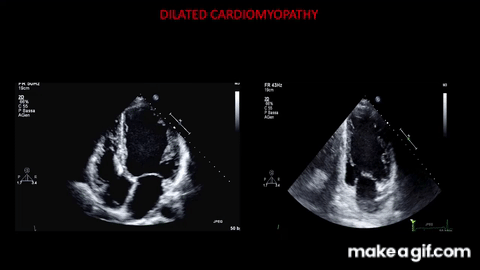 Echocardiography in dilated cardiomyopathy on Make a GIF