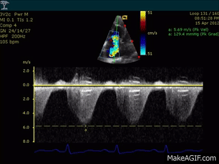 Echocardiogram Cor Pulmonale, PHTN, Pulmonary Hypertension. on Make a GIF