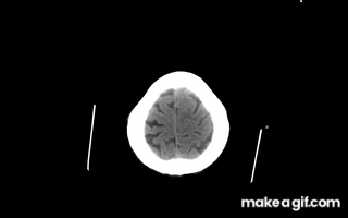 TC CRANIO AVC HEMORRAGICO on Make a GIF