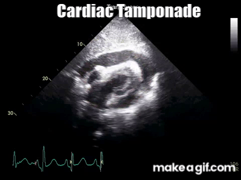 Echocardiogram of a Patient With Cardiac Tamponade on Make a GIF