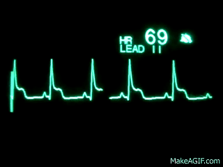 ST Elevation on Make a GIF