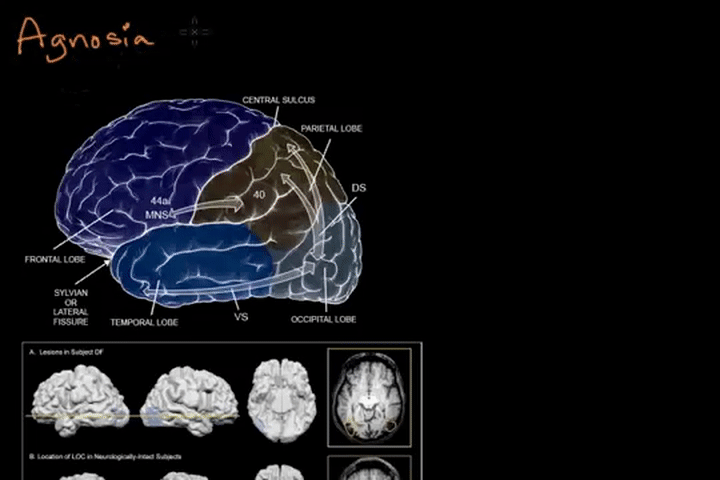 02 Visual form agnosia on Make a GIF
