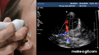 How To Transcranial Doppler on Make a GIF
