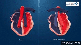 Transposición de las grandes arterias TGA on Make a GIF