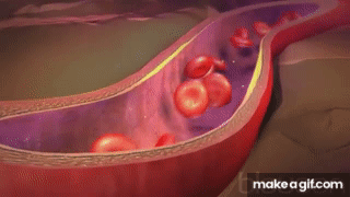 Así se produce un infarto de miocardio on Make a GIF