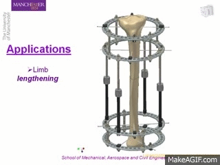Ilizarov External Fixator extending on Make a GIF