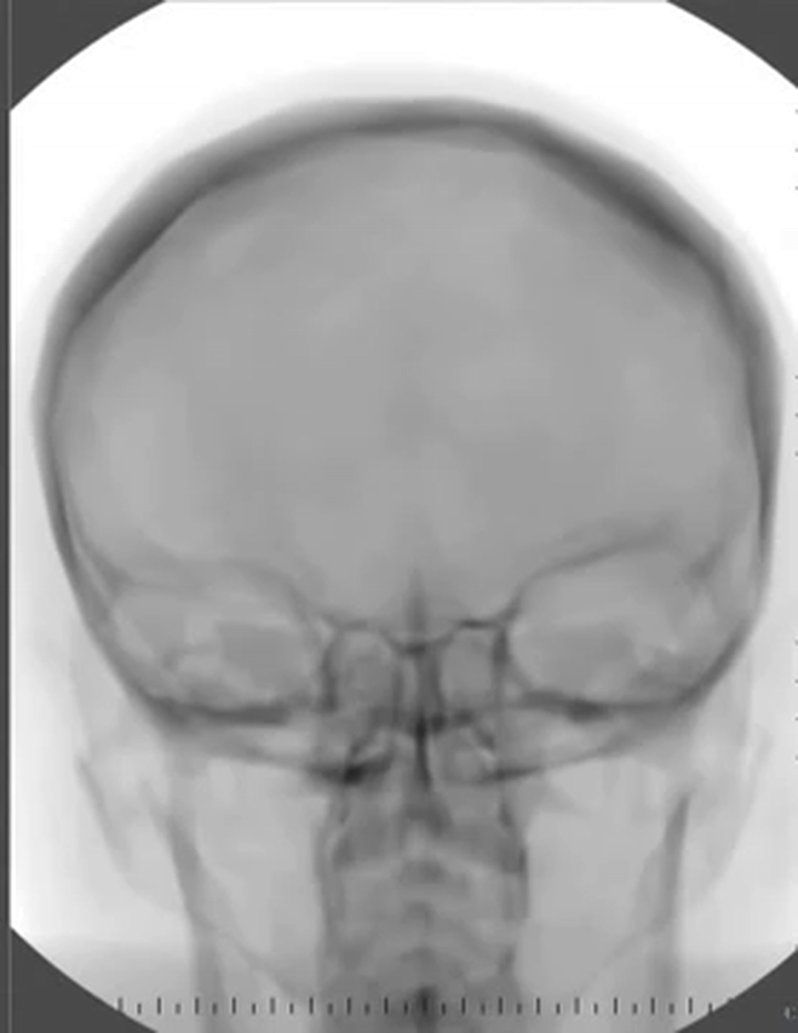 Pre and Post Cerebral Angiography on Simbionix ANGIO Mentor on Make a GIF