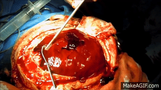 Acute Subdural Hematoma on Make a GIF
