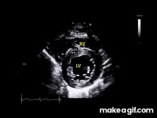Basic cardiac ultrasound views 3D orientation I POCUS I Dr. Koratala on ...
