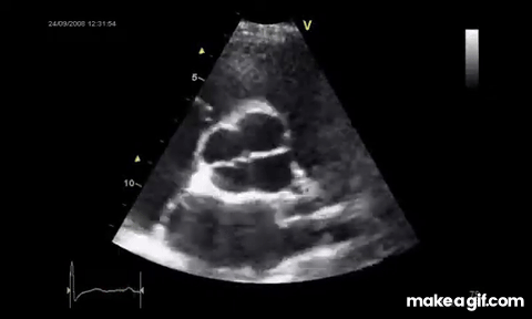 Quadricuspid aortic valve (QAV) | Aortic Valve with Four Leaflets ...