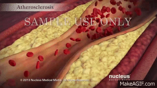 Acute Coronary Syndrome and Heart Attack on Make a GIF