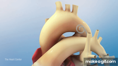 Patent Ductus Arteriosus (PDA) Occlusion Procedure on Make a GIF