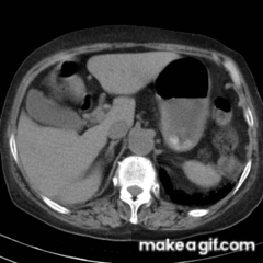renal stone on Make a GIF