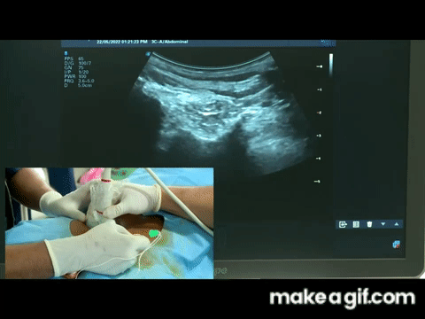 Sacroiliac Joint Injection under USG | Ultrasonography guided SI joint ...