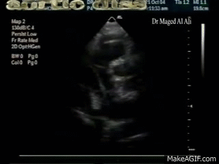 Type A aortic dissection : TTE on Make a GIF