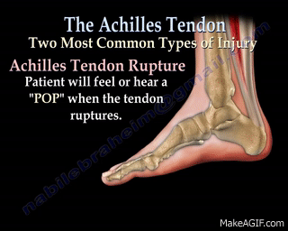 Achilles Tendon rupture ,tear, tendonitis - Everything You Need To Know ...