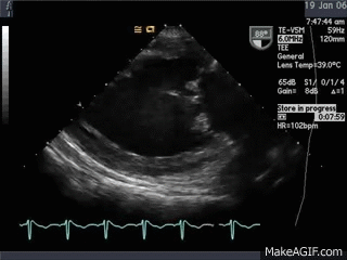 Ruptured Papillary Muscle on Echocardiogram on Make a GIF