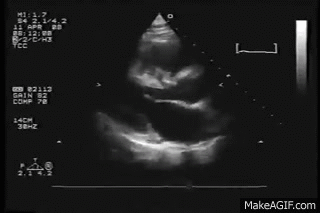 Heart UltraSound Comparison - Hypertrophic Cardiomyopathy [healthy ...