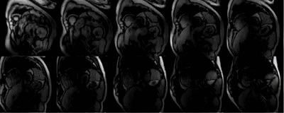 Whole Heart Perfusion on Make a GIF