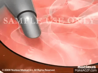 Cataract Surgery (2009) on Make a GIF