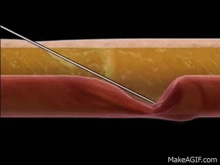 Placement of Central Venous Catheter - NEJM on Make a GIF