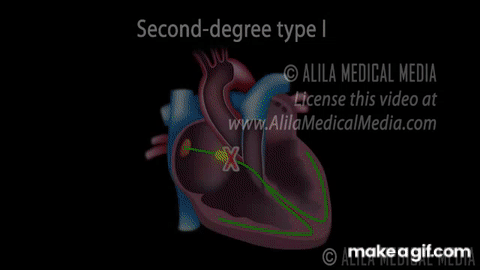 Atrioventricular Block (AV block) - Types of Heart Block Part 2 ...