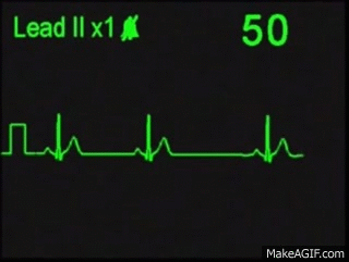 Sinus Arrest - ECG Simulator - Arrhythmia Simulator on Make a GIF