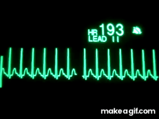 Taquicardia supraventricular con cardioversión sincronizada (A.S) on ...