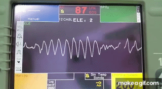 Taquicardia Ventricular Polimorfica 🤯🤯 on Make a GIF