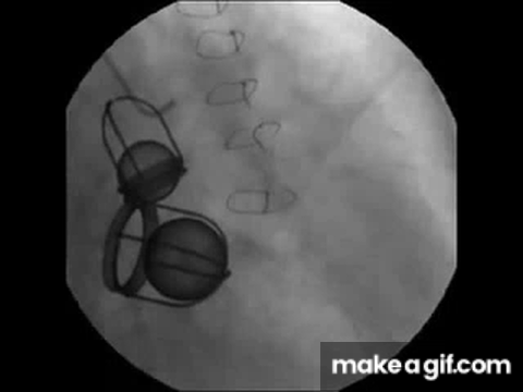 Two Views of the StarrEdwards Valves during Cardiac Catheterization. on ...