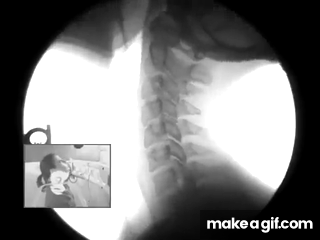 Video Fluoroscopy of my neck on Make a GIF