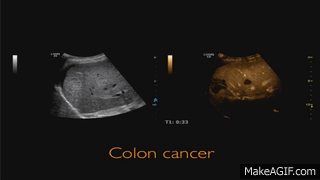 Role of Contrast Ultrasound and Elastography in Liver and Gallbladder ...