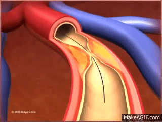 What is ANGIOPLASTY and STENTING? on Make a GIF