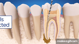 Root Canal Treatment Step by Step on Make a GIF