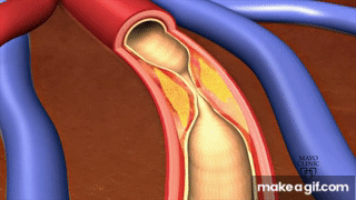 Animation - Coronary stent placement on Make a GIF