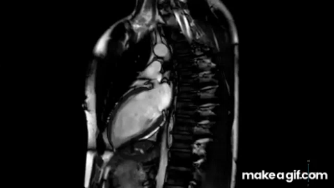 Cardiac MRI scan of a heart beating in high resolution - ECG gated CMRI ...