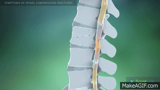 허리 압박골절, 뼈 붙는 시기부터 완치까지 총정리 (정형외과 전문의 설명) : 네이버 블로그
