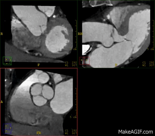 CT/TC Multislice Cardiac Valves - Válvula Cardíacas Cine on Make a GIF
