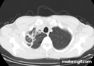 CT Chest on Make a GIF